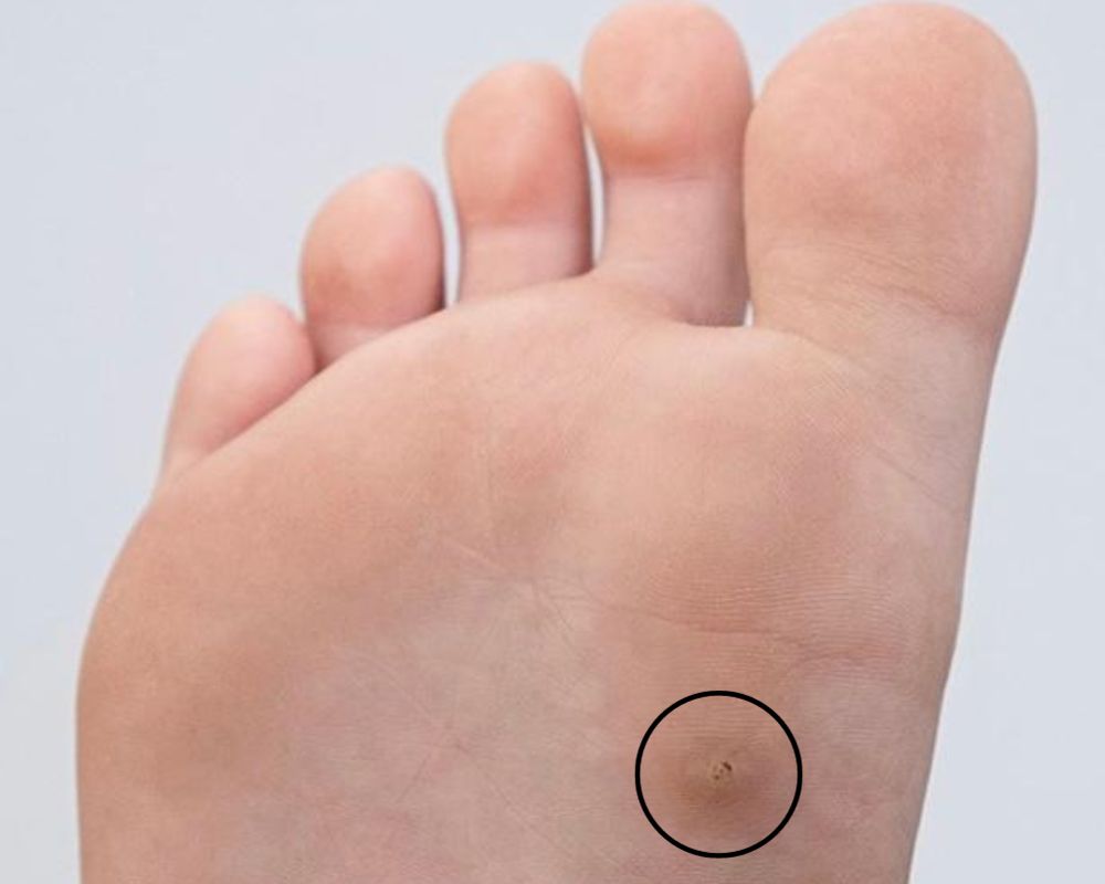 Verrugas plantares: qué son y cuál es su tratamiento